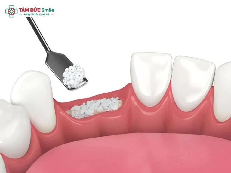 Bone Graft for Dental Implant: Types, Procedure, Cost & Healing