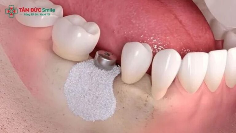 Bone Graft for Dental Implant: Types, Procedure, Cost & Healing