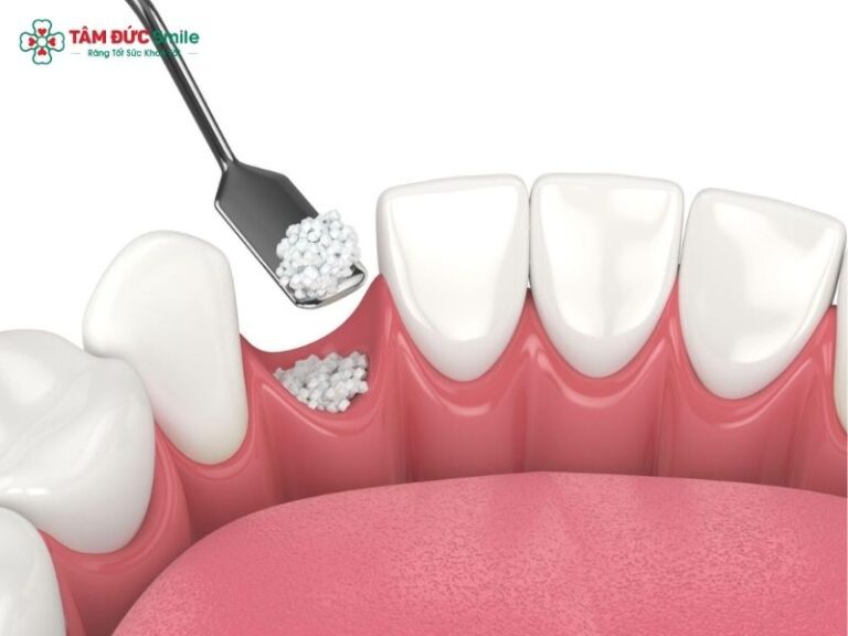 Bone Graft for Implant: Types, Healing Time & Implant Stability Guide