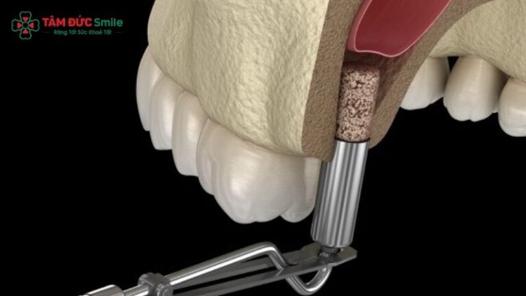 Bone Graft for Implant: Types, Healing Time & Implant Stability Guide
