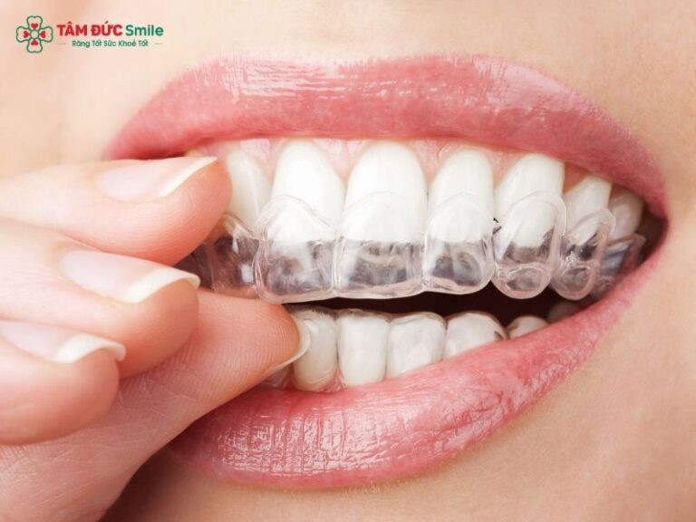 Clear Aligners: Invisible Braces Benefits, Cost & Treatment Guide