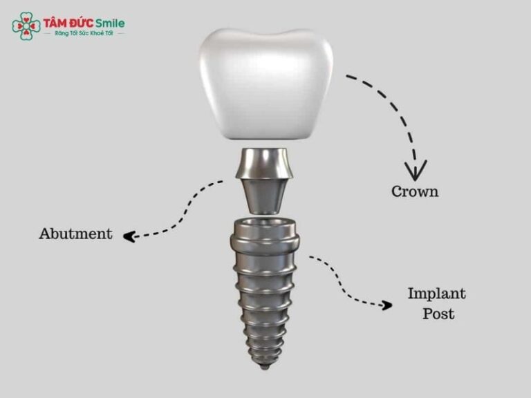 Dental Implant Components: Parts, Materials & Implant System Explained