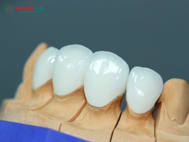 Dental Implant Crown Guide: Materials, Costs & Benefits Explained