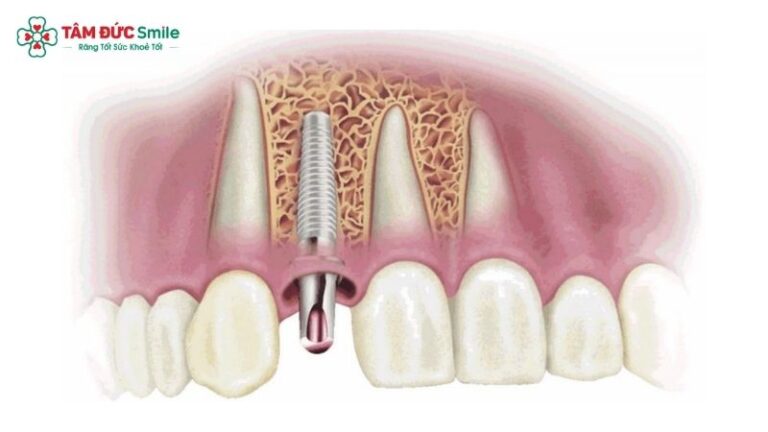 Dental Implant Healing Timeline, Osseointegration & Recovery Care Guide