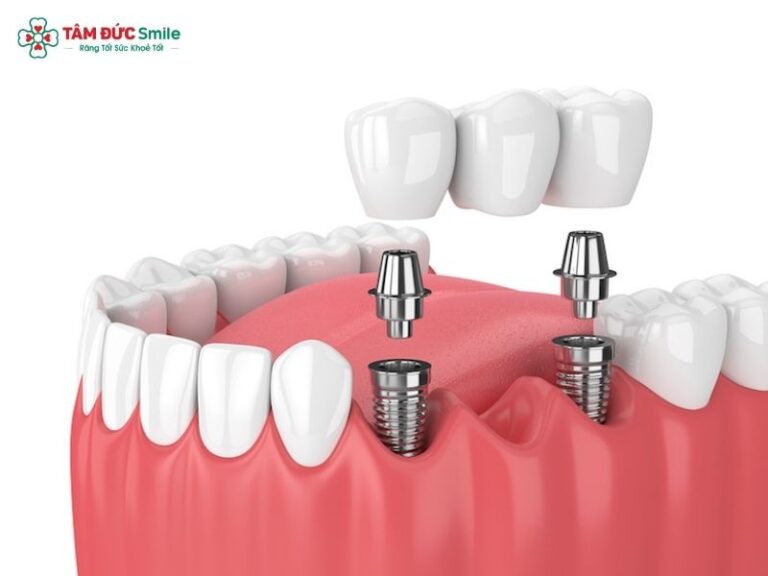 Implant Abutment Guide: Types, Materials, Costs & Clinical Uses
