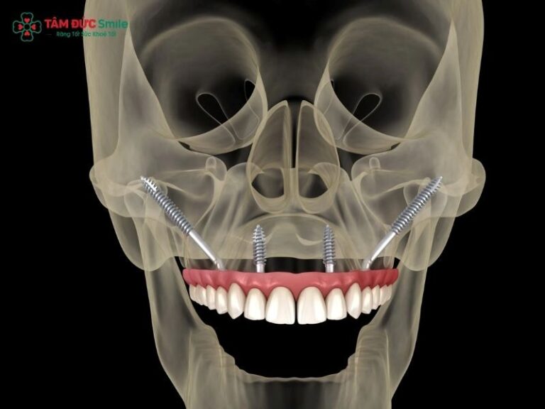 Zygomatic Dental Implants: Cheekbone Solution for Severe Upper Jaw Bone ...