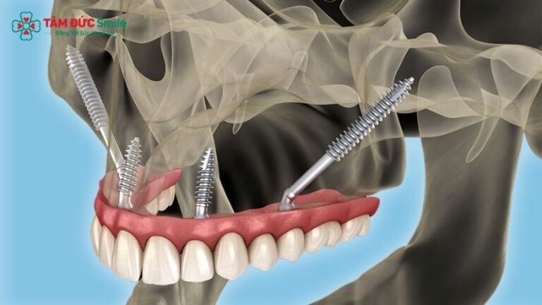 Zygomatic Dental Implants: Cheekbone Solution for Severe Upper Jaw Bone ...